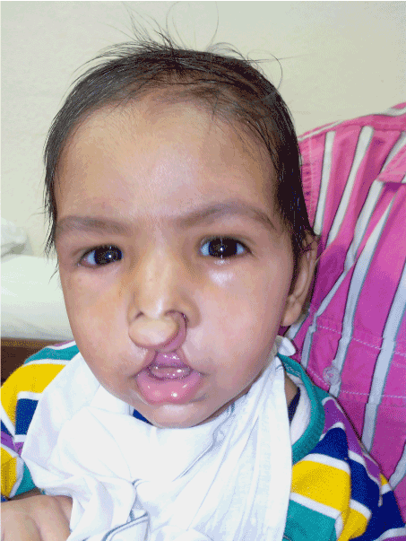 Perinatal and anesthetic management in Simpson-Golabi-Behmel syndrome ...