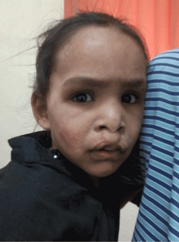 Perinatal and anesthetic management in Simpson-Golabi-Behmel syndrome ...