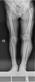 Total knee arthroplasty in a patient with Klippel Trenaunay Weber syndrome