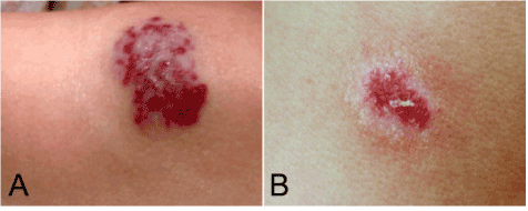Unusual multiple cutaneous retiform hemangioendothelioma on forearm and ...