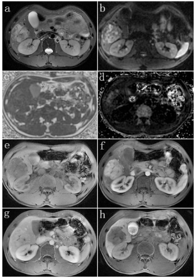 Hepatic epithelioid angiomyolipoma with prominent invasive growth ...
