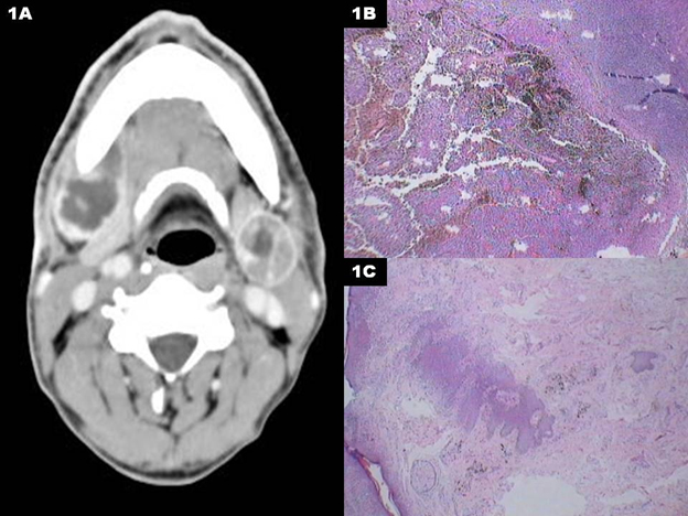 Bilateral Cervical Nodal Metastasis from Unknown Primary Melanoma: A ...