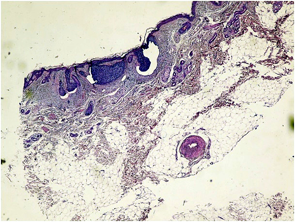 Clinical and histopathological profile of basal cell carcinomas of the ...
