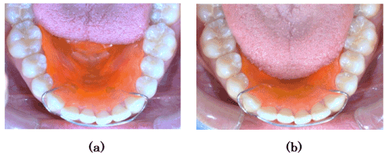Influence of tongue movements on masticatory efficiency