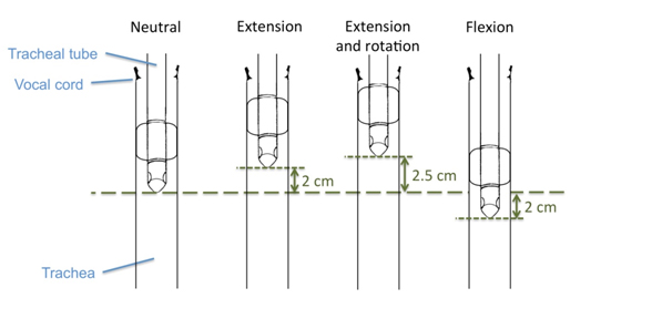 Determination of tracheal tube insertion depth for dental procedure and ...