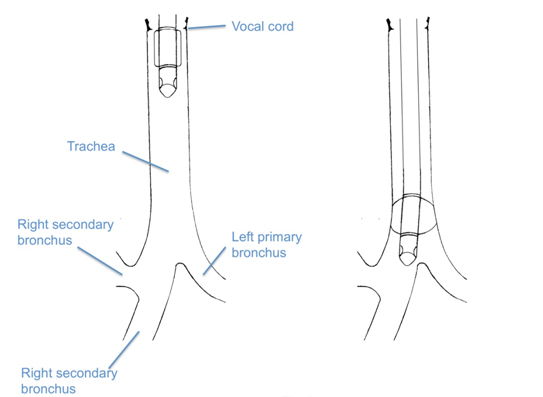 Determination of tracheal tube insertion depth for dental procedure and ...
