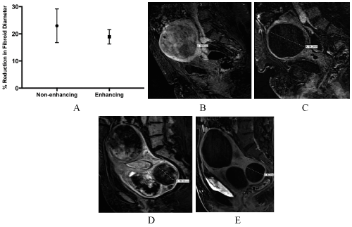 MRI enhancement predicting fibroid volume reduction to uterine artery ...