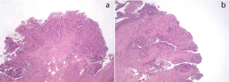 Polypoid adenomyomas with extensive endometrial, myometrial, or ...