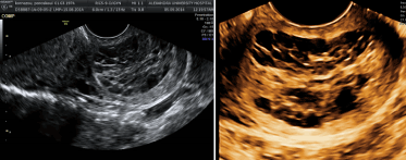 Polypoid adenomyomas with extensive endometrial, myometrial, or ...