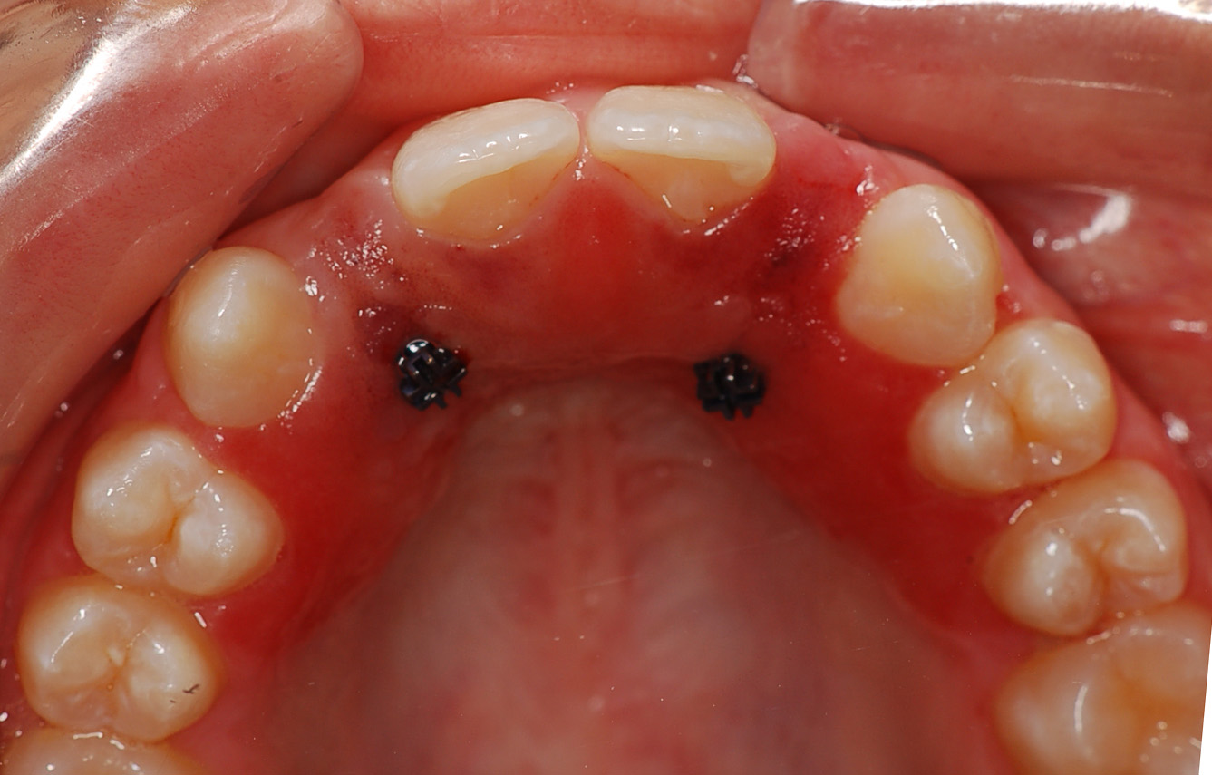 Semi-permanent replacement of missing maxillary lateral incisors with ...