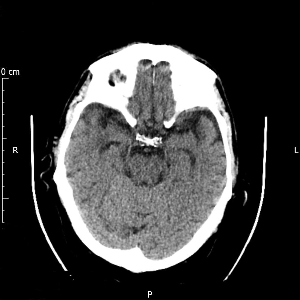 Second thrombolysis with recombinant tissue-type plasminogen activator ...