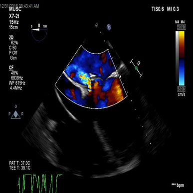 Dehiscence of a bioprosthetic mitral valve without endocarditis: A case ...