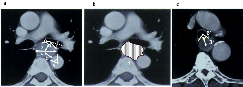 The assessing the left bronchial invasion of esophageal cancer in ...