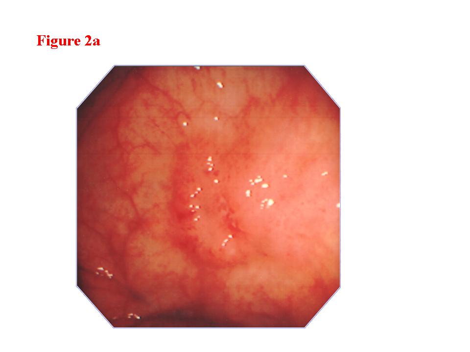 Thin-probe endoscopic ultrasonography for surgical resection of early ...