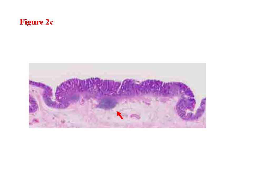 Thin-probe endoscopic ultrasonography for surgical resection of early ...