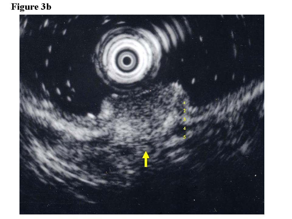 Thin-probe endoscopic ultrasonography for surgical resection of early ...