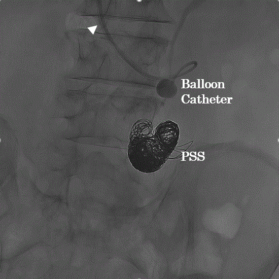 Portosystemic shunt occlusion with balloon-occluded retrograde ...