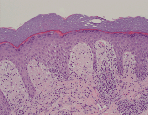 Acral papulovesicular eruption to smallpox vaccination