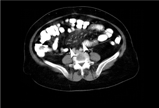 CT and MRI aspect of mesenteric panniculitis