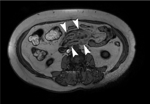 CT and MRI aspect of mesenteric panniculitis