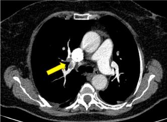 Cerebral venous thrombosis and pulmonary embolism in patient with ...