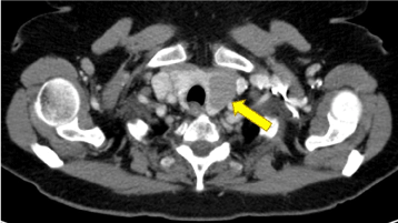 Cerebral venous thrombosis and pulmonary embolism in patient with ...