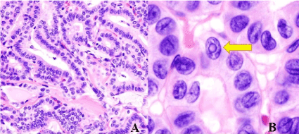 Cerebral venous thrombosis and pulmonary embolism in patient with ...