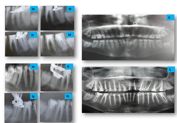 Endodontic management of c-shaped canal system in mandibular second ...