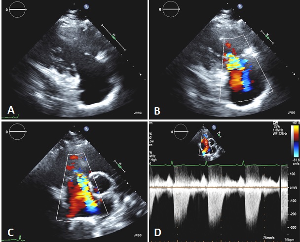 Carcinoid heart disease and recurrent hypertensive crises in a patient ...
