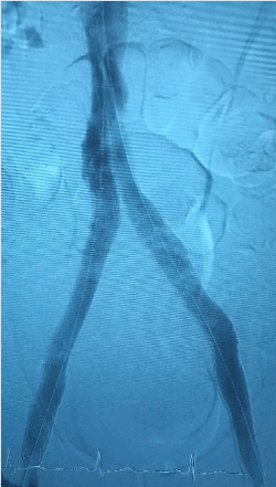 Iliocaval stent reconstruction following inferior vena cava filter ...