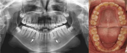 Development of supernumerary premolars in the mandible after ...