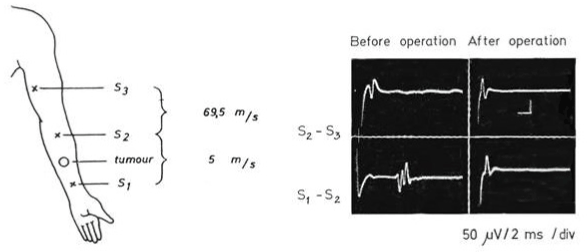 Why electromyoneurography instead of electromyography and ...