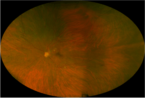 The use of ultra-widefield retinal imaging in the setting of de Morsier ...