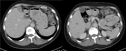 Hepatic Superscan on a PET- CT scan of a patient with metastatic breast ...