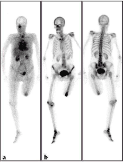 Toxic multinodular goitre identified at vascular and late phase of ...