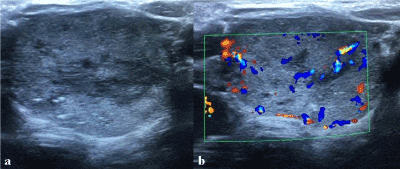 Toxic multinodular goitre identified at vascular and late phase of ...