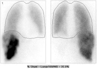 Spectrum of findings in 99mTc-MAA SPECT/CT and their significance in ...