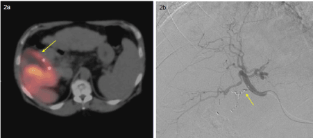 Spectrum of findings in 99mTc-MAA SPECT/CT and their significance in ...