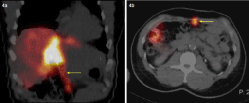 Spectrum of findings in 99mTc-MAA SPECT/CT and their significance in ...