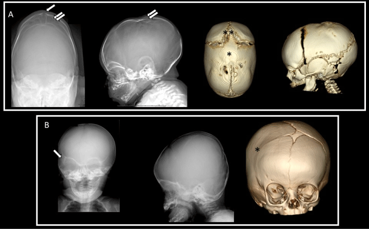 Lambdoid Suture X Ray