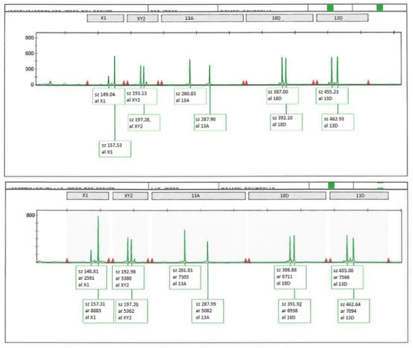A case of blood chimerism and twin-to-twin transfusion syndrome in ...