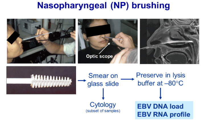 Nasopharyngeal Carcinoma The Lancet