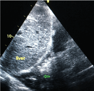 Diagnostic accuracy of chest ultrasound in patients with pneumonia in ...