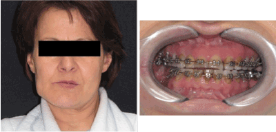Unilateral condylar hyperplasia recurrence after orthognathic surgery ...