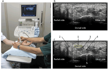 Ultasonographic indicators of carpal tunnel syndrome demonstrate ...