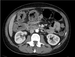 Ameboma versus colorectal cancer: a case report