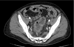 Ameboma versus colorectal cancer: a case report