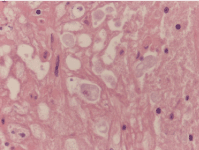 Ameboma versus colorectal cancer: a case report