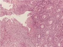 Ameboma versus colorectal cancer: a case report