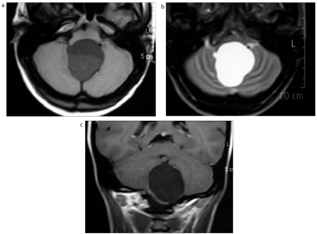 Neuroglial Cyst Non Neoplastic Cystic Lesions Of The Central Nervous